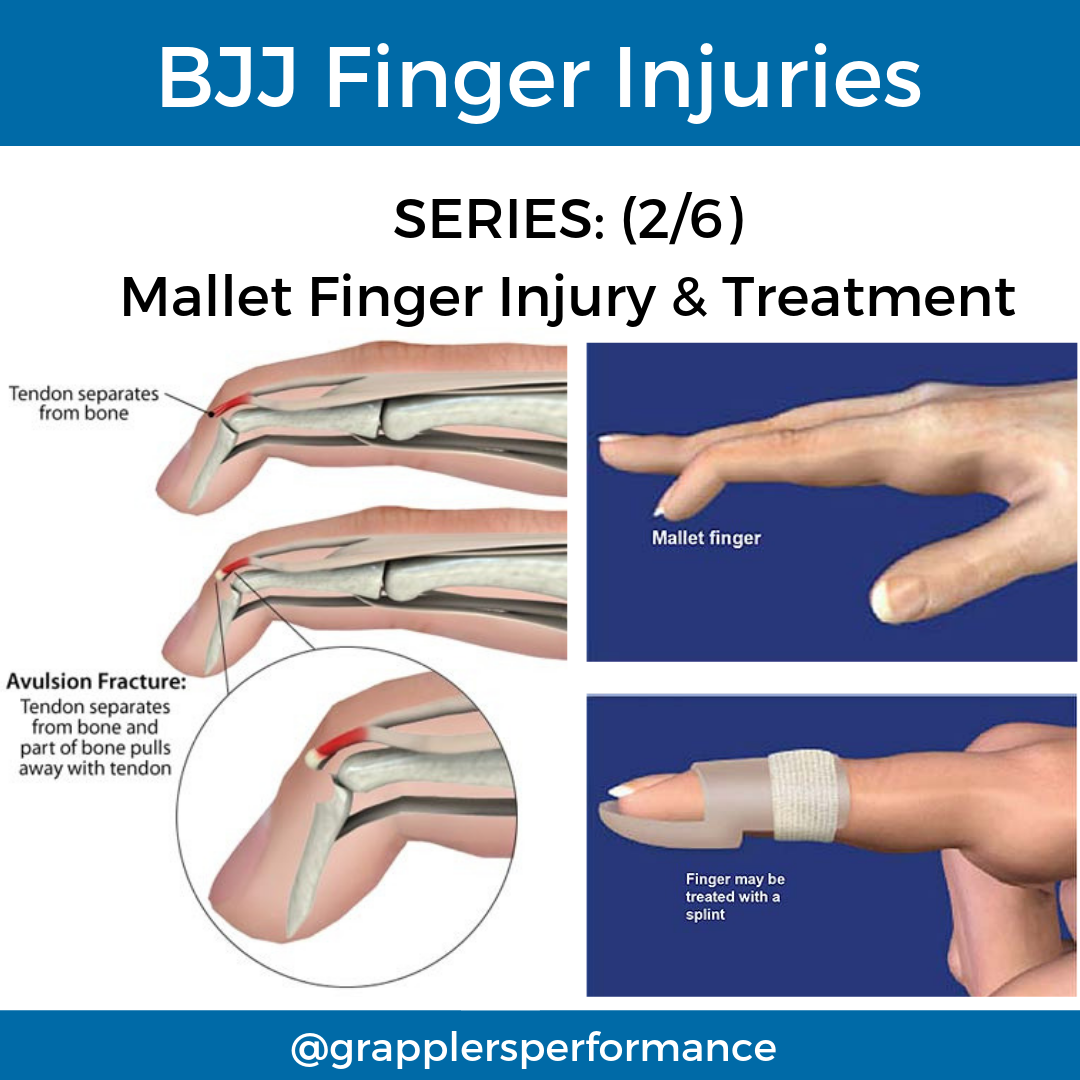 Common BJJ Finger Injuries: Part 2 - Grapplers Performance